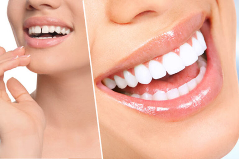 Invisalign Effectiveness Enhancement for Gapped Teeth - Onshore ...